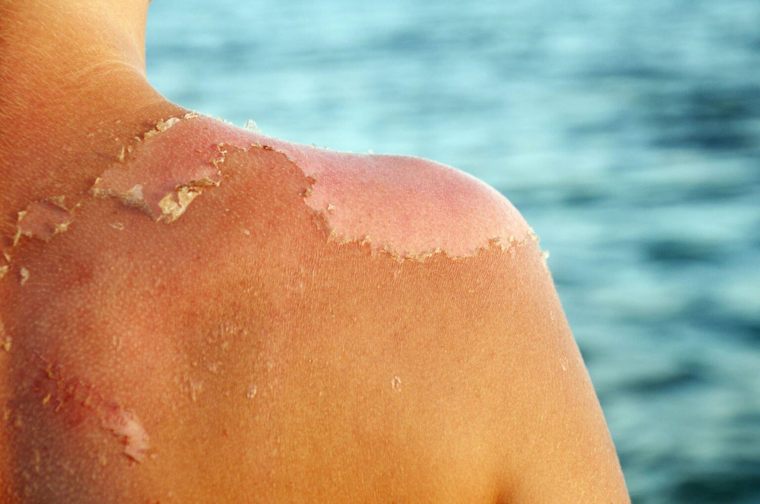 4 Signs Of Skin Cancer You Shouldn t Ignore 4-signs-of-skin-cancer-you-shouldn-t-ignore